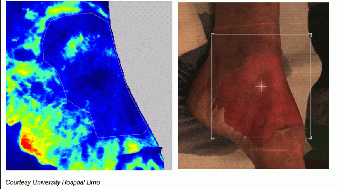 Accurate assessment of burn depth at an early stage