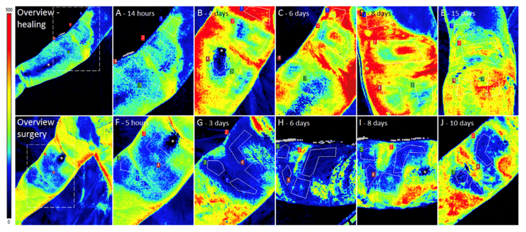 Assessment of scald burns in children using Laser Speckle Contrast ...